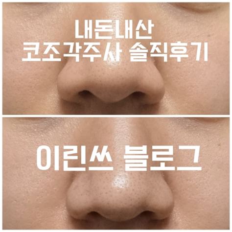 복코의 코조각주사 콧볼보톡스 내돈내산 솔직 후기와 전후사진 네이버 블로그