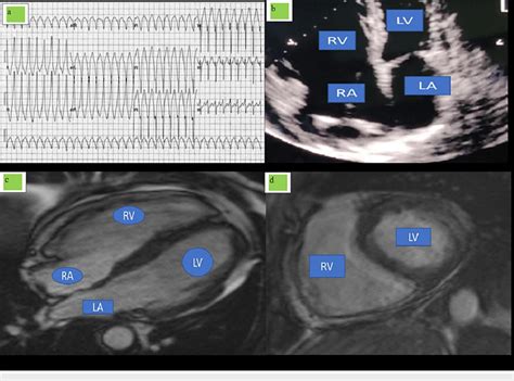 Ecg 2d Echo And Mri Findings Of Case 2 A Ecg Showed Frequent