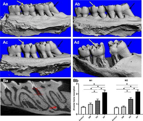 Periodontitis Promotes The Progression Of Diabetes Mellitus By