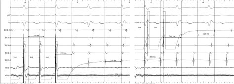 Iatrogenic Biatrial Flutter The Role Of The Bachmanns Bundle