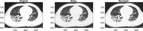 Original Computed Tomography Ct Image Noisy And Denoised Images By