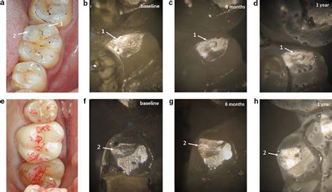 Image Of The Monolithic Zirconia Crown On The Wear Of Antagonist Teeth