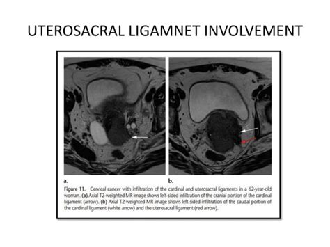Target Delineation Of Parametrium Pptx