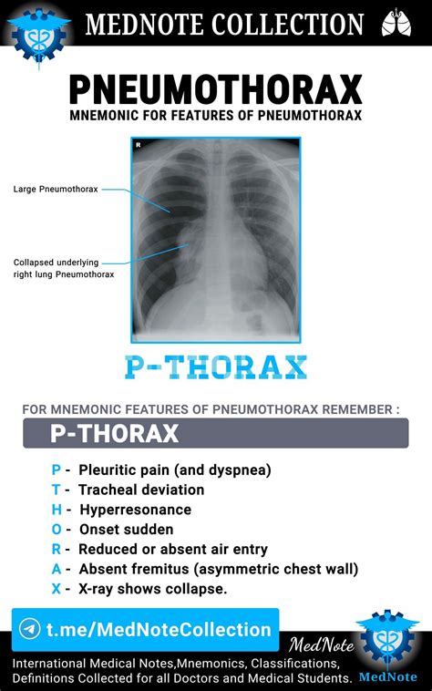 Pneumothorax Mnemonic For Features Medical School Stuff Medical