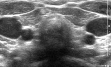 Thyroid Patho Flashcards Quizlet