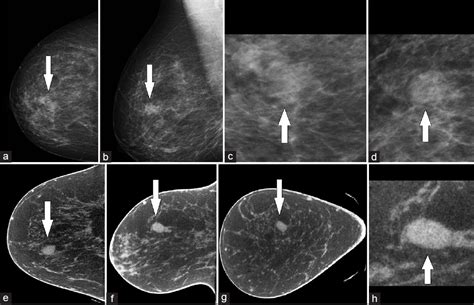 Dedicated Three Dimensional Breast Computed Tomography Lesion