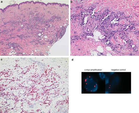 The Biopsy Of Case 42 Shows Features Of A Moderately Differentiated Download Scientific Diagram