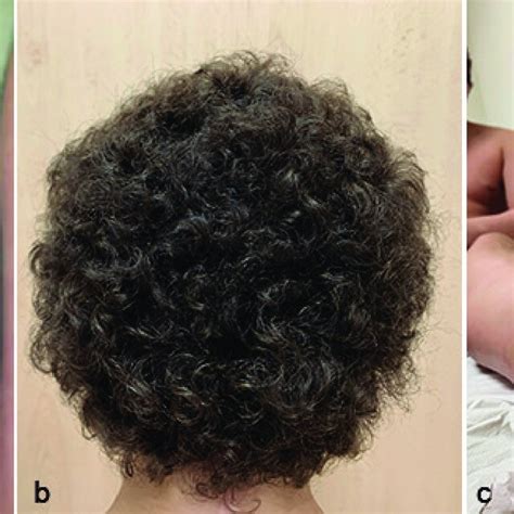 Cutaneous Adverse Effects Of Dabrafenib A Panniculitis B Curly