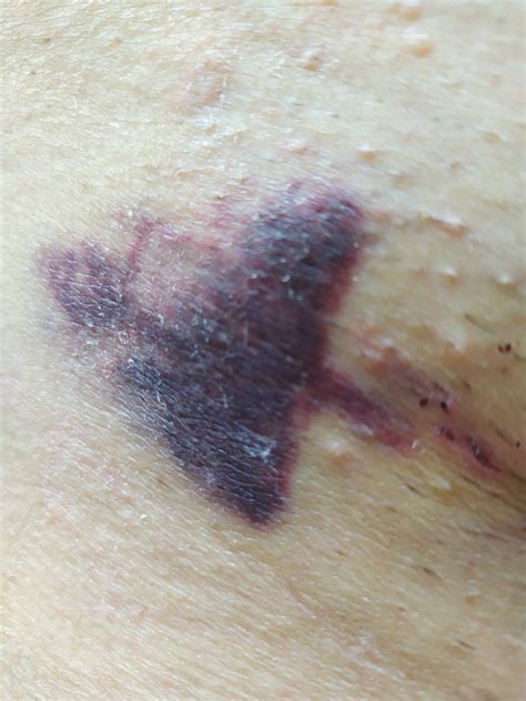 Just Had An Angiogram A Couple Days Back Is This Normal To Happen At The Site Of Injection R