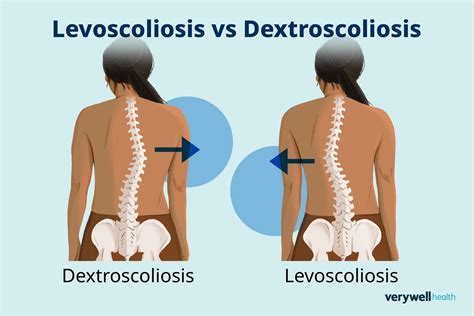 Severe Thoracic Scoliosis