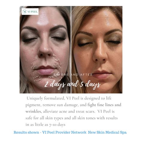 Keep Breakouts At Bay With Vi Peel Savannah