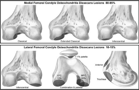 Osteochondritis Dissecans Of The Knee Musculoskeletal Key