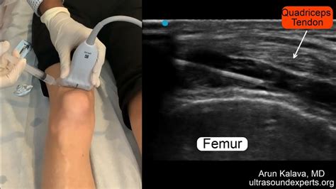 Ultrasound Guided Intra Articular Knee Injection Youtube