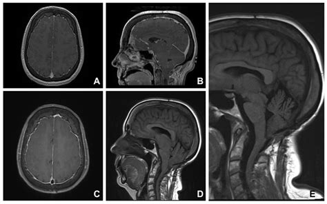 Chiari Mimic Spontaneous Intracranial Hypotension A 51 Year Old Woman