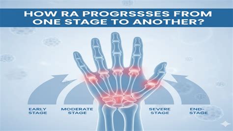 Understanding The Stages Of Ra Rheumatoid Arthritis