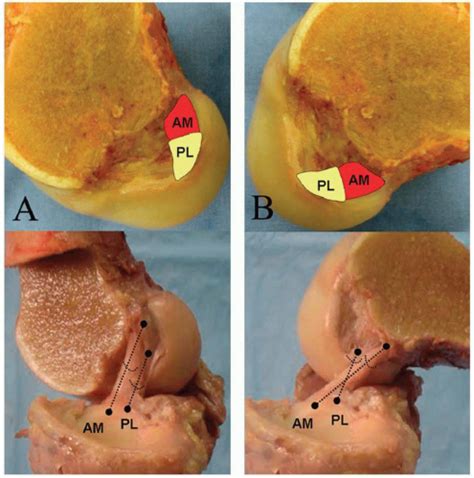 Anatomic Double Bundle Acl Reconstruction Musculoskeletal Key