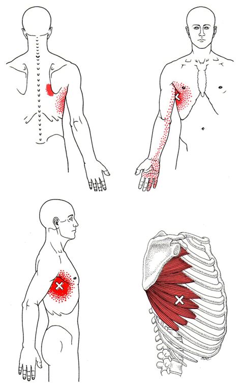 Serratus Posterior Superior Trigger Point Ep 328 The Serratus