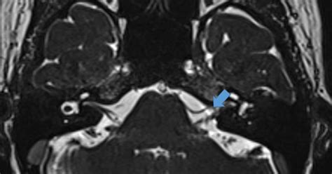 Ultimate Radiology Vascular Loops In Internal Acoustic Canal Iac