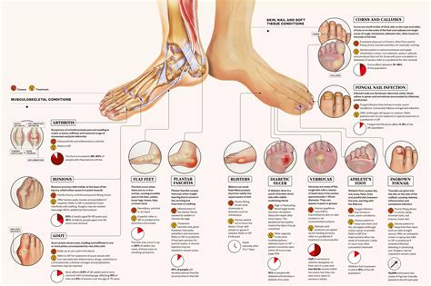 Different Types Of Foot Diseases At Walter Cargill Blog