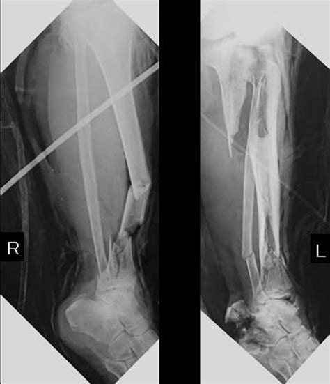 Radiographs Showing Bilateral Comminuted Tibia And Fibula Fractures