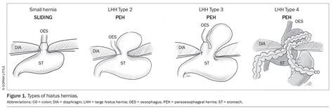 Large Hiatus Hernias More Than Just Reflux Medicine Today