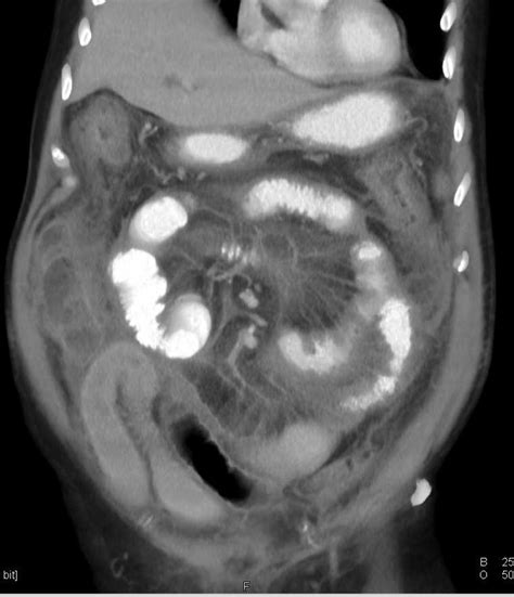Infectious Enterocolitis Small Bowel Radiology Case Studies Ctisus