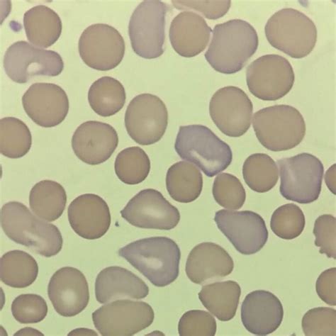 Polychromasia Medlabbuddy