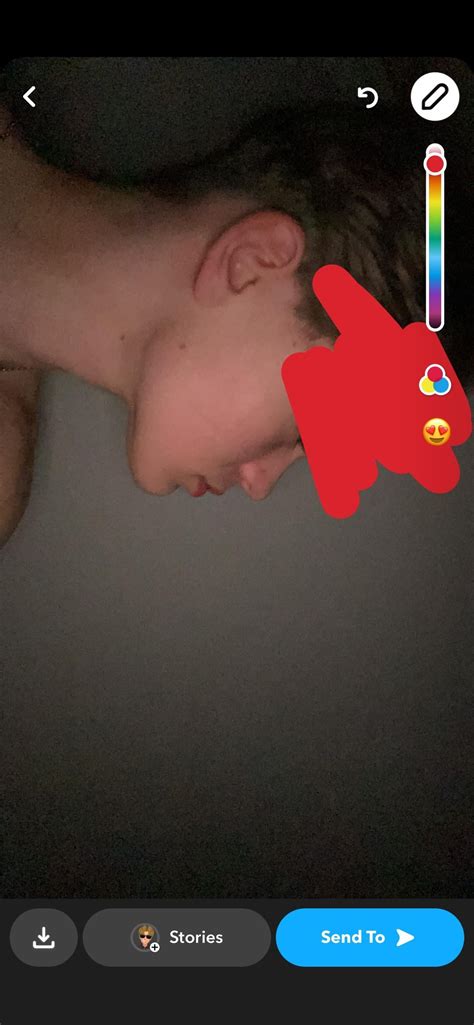 Progress In Maxilla Forward Growth Left Before Right After Am I