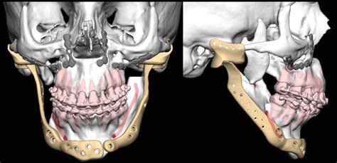 Alloplastic Temporomandibular Total Joint Replacement Intechopen