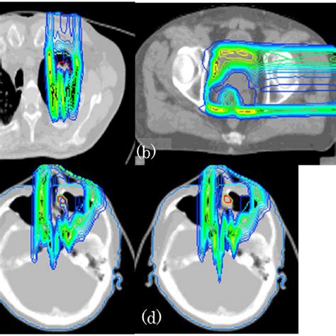 The Dose Sds Calculated By The Dose Warping Method With The Setup Error