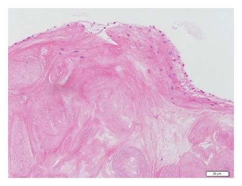 Microscopical Analysis Of The Resected Specimen Revealed A Single