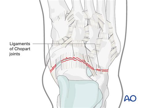 Treatment Of Chopart Injuries For Chopart Injuries