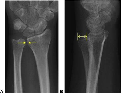 Figure 2 From Bidirectional Dislocation Of The Distal Radioulnar Joint