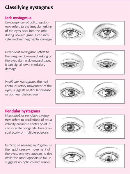 23 Best Nystagmus Images On Pinterest