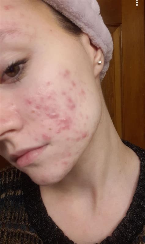Finished Accutane Raccutane