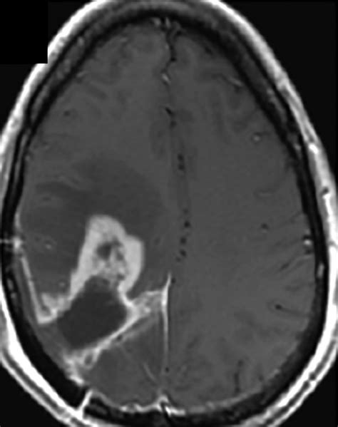 Imaging Genetic Heterogeneity In Glioblastoma And Other Glial Tumors Review Of Current Methods