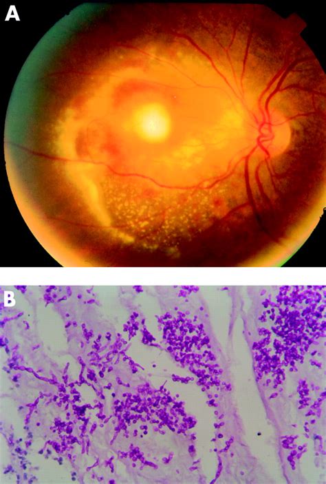 Bilateral Aspergillus Endophthalmitis In A Patient With Chronic