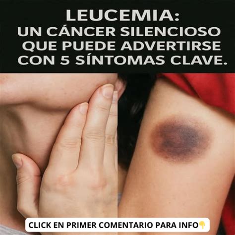 Leucemia 5 Síntomas Clave Para Detectarla A Tiempo Noticias Cristianas