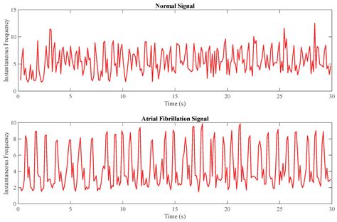 Mathematics Free Full Text Enhanced Classification Of Heartbeat Electrocardiogram Signals