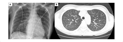 A Chest Radiograph Revealing Mild Diffuse Interstitial Prominence And Download Scientific