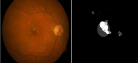 4 Example Of Abnormal Fundus Image From Diaretdb1 Database Left And