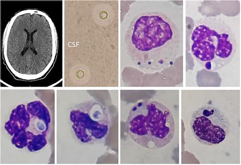 Cryptococcus Neoformans In Cerebrospinal Fluid And Blood Pmc