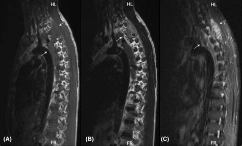 Spinal Mri Sagittal View Large Paravertebral Lobulated Soft Tissue Download Scientific