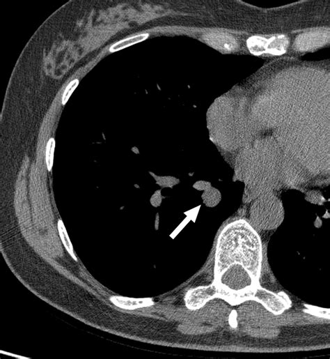 Ct Features Of Peripheral Pulmonary Carcinoid Tumors Ajr