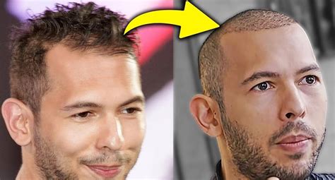 Tristan Tate Hair Transplant Journey Confidence Restored