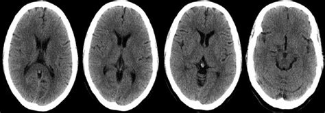A 50 Year Old Female Patient Who Has Sulcal Hyperintensity On