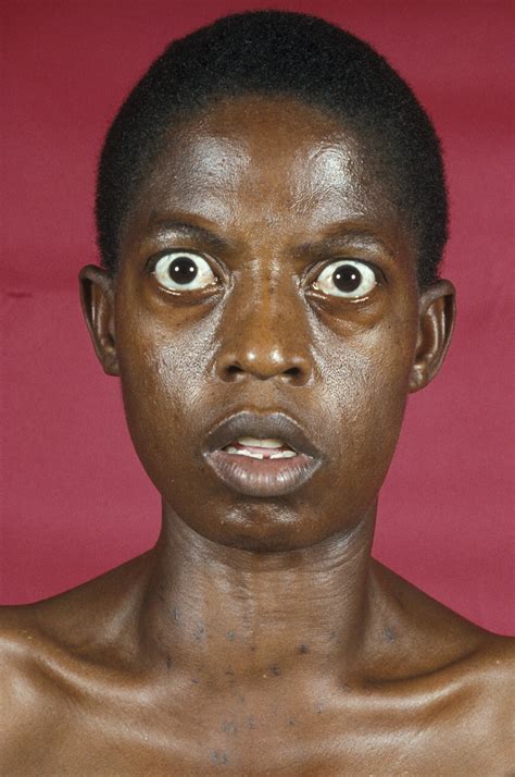 Hyperthyroidism Face