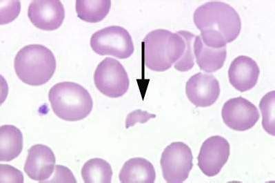 Pathologic Rbc Forms Abnormal Red Cell Morphologies