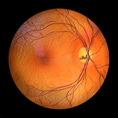 A Prepapillary Vascular Loop On The Retina 3d Illustration Stock