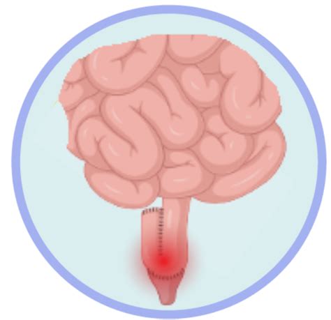 Classifications Ibd Eii